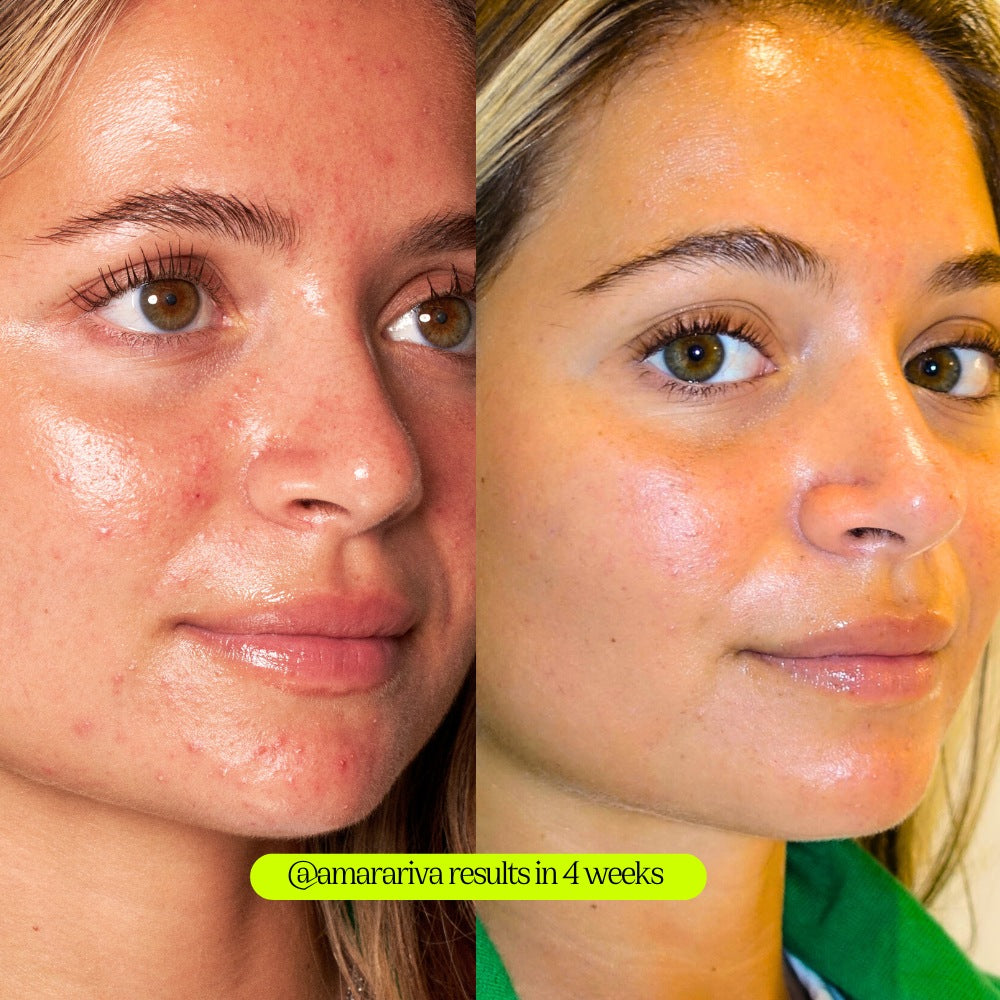 Natural spot and acne treatment cream with crystal elixir – eyeam
